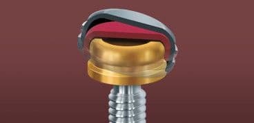 Implant Direct™ Dental Implants - Preat Corporation