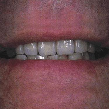 Vertix “P” Attachment - Preat Corporation