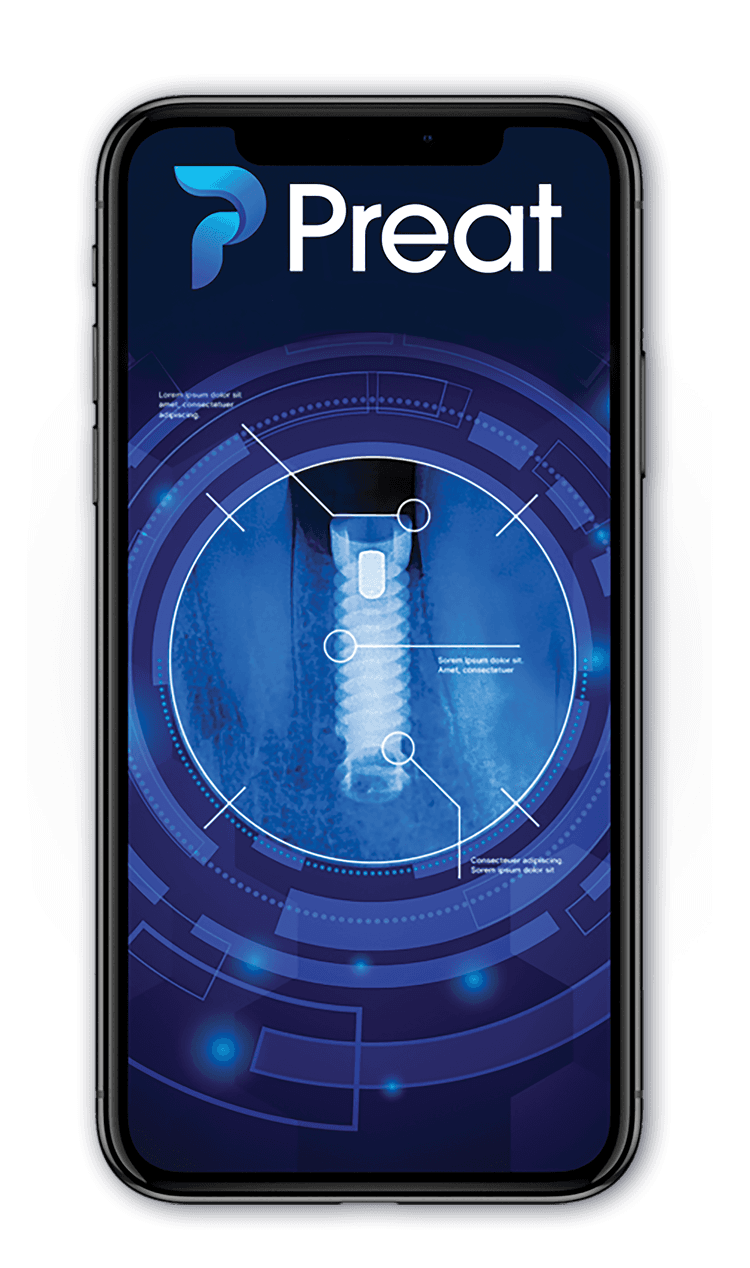 Preat Dental Implant Attachments and Implant Abutments - Preat Corporation
