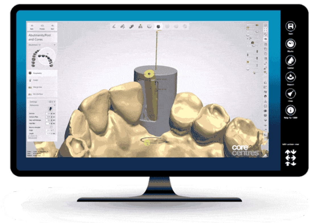 Preat Patient-Specific Abutments - Preat Corporation