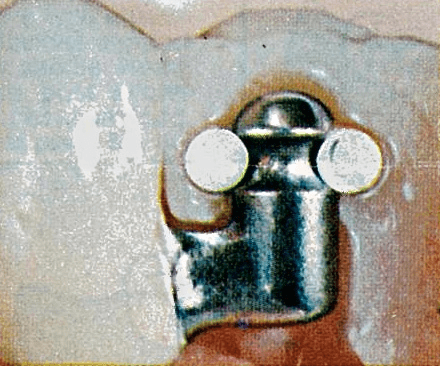 O-Ring Attachment System - Preat Corporation