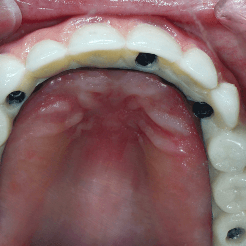 Preat Patient-Specific Bars - Preat Corporation