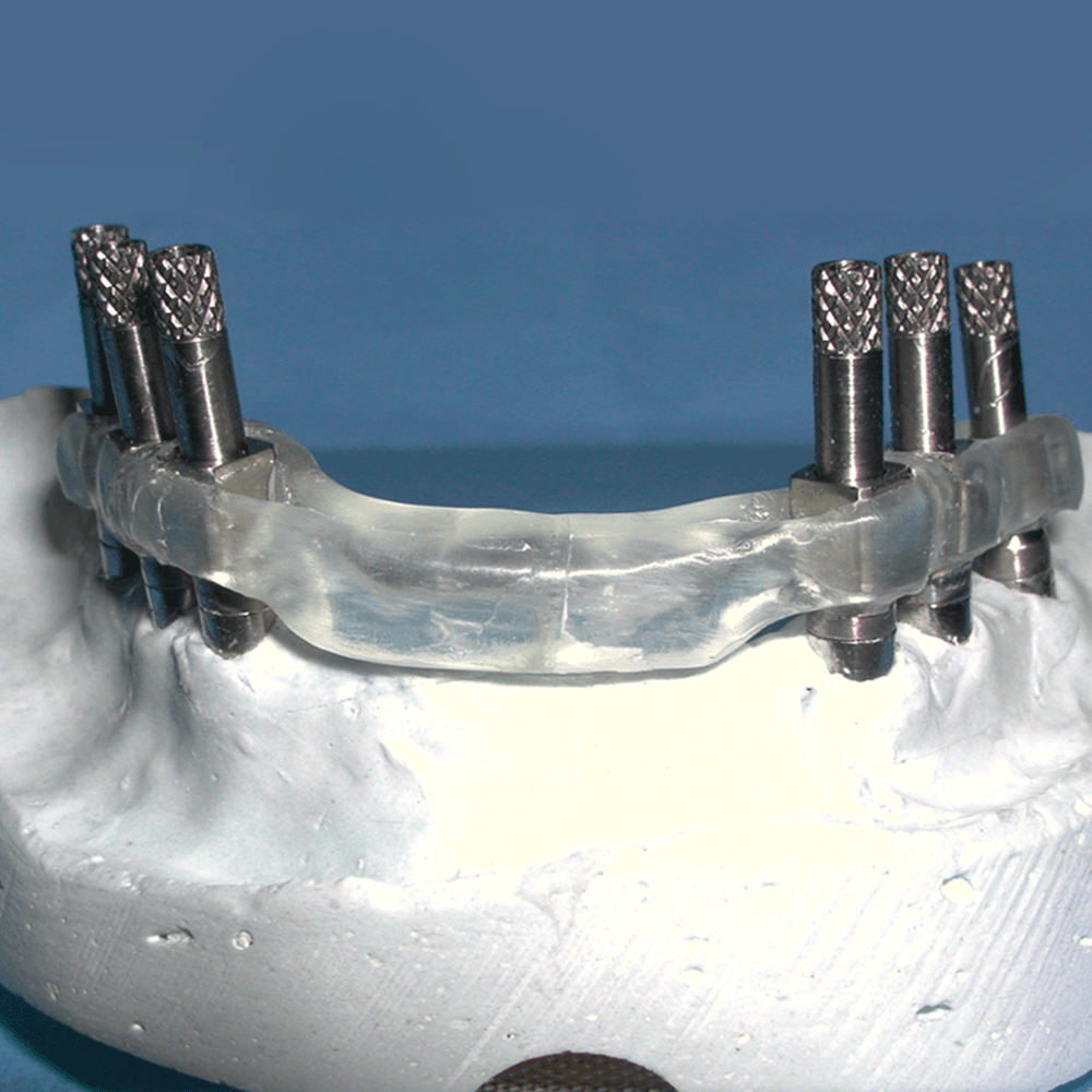 Preat Patient-Specific Bars - Preat Corporation
